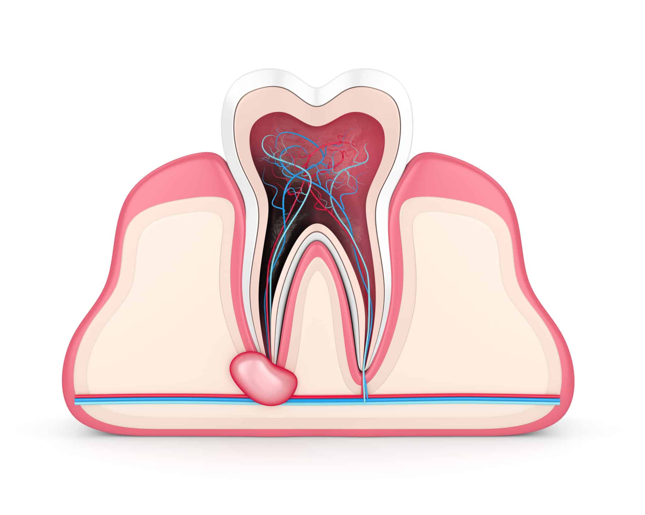 What Is Tooth Abscess? Symptoms And Treatment From Your Dentist